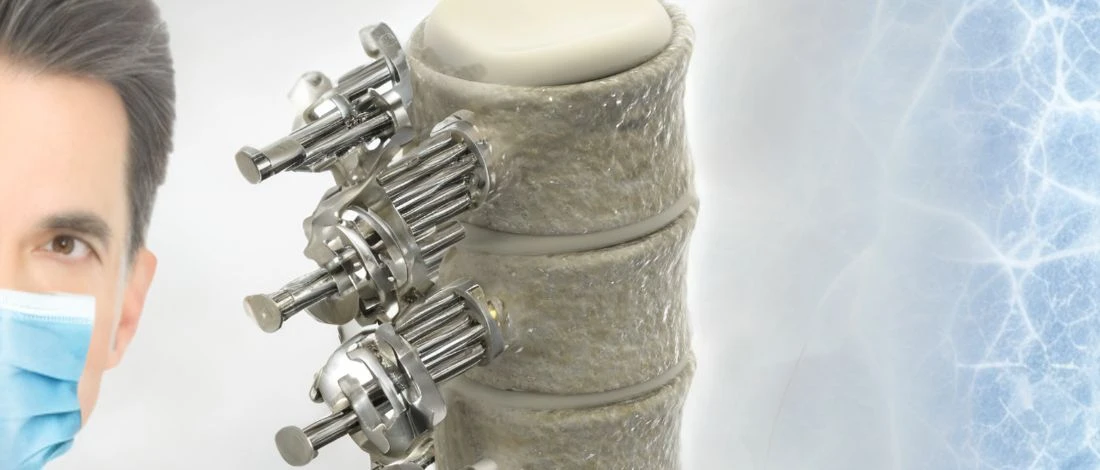 Medtronic CD Horizon Spinal System Lawsuit Update