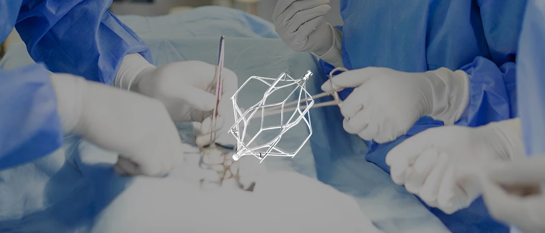 Optease IVC Filter Lawsuit (2025 Update) Free Case Review