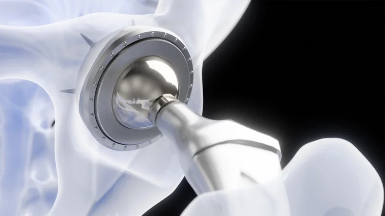 Zimmer Durom Acetabular Cup Lawsuit (2025 Update)